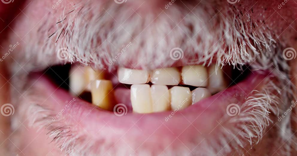 Smile with Missing Tooth stock photo. Image of mouth - 283344184