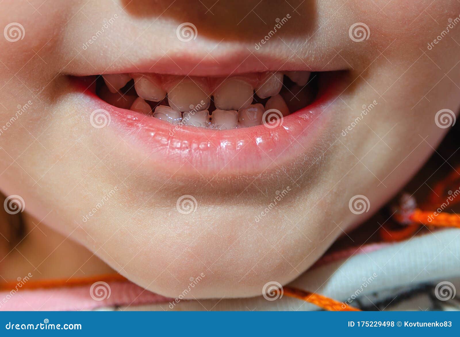Smile with the Teeth of a Young Child, Preschool Stock Photo - Image of ...