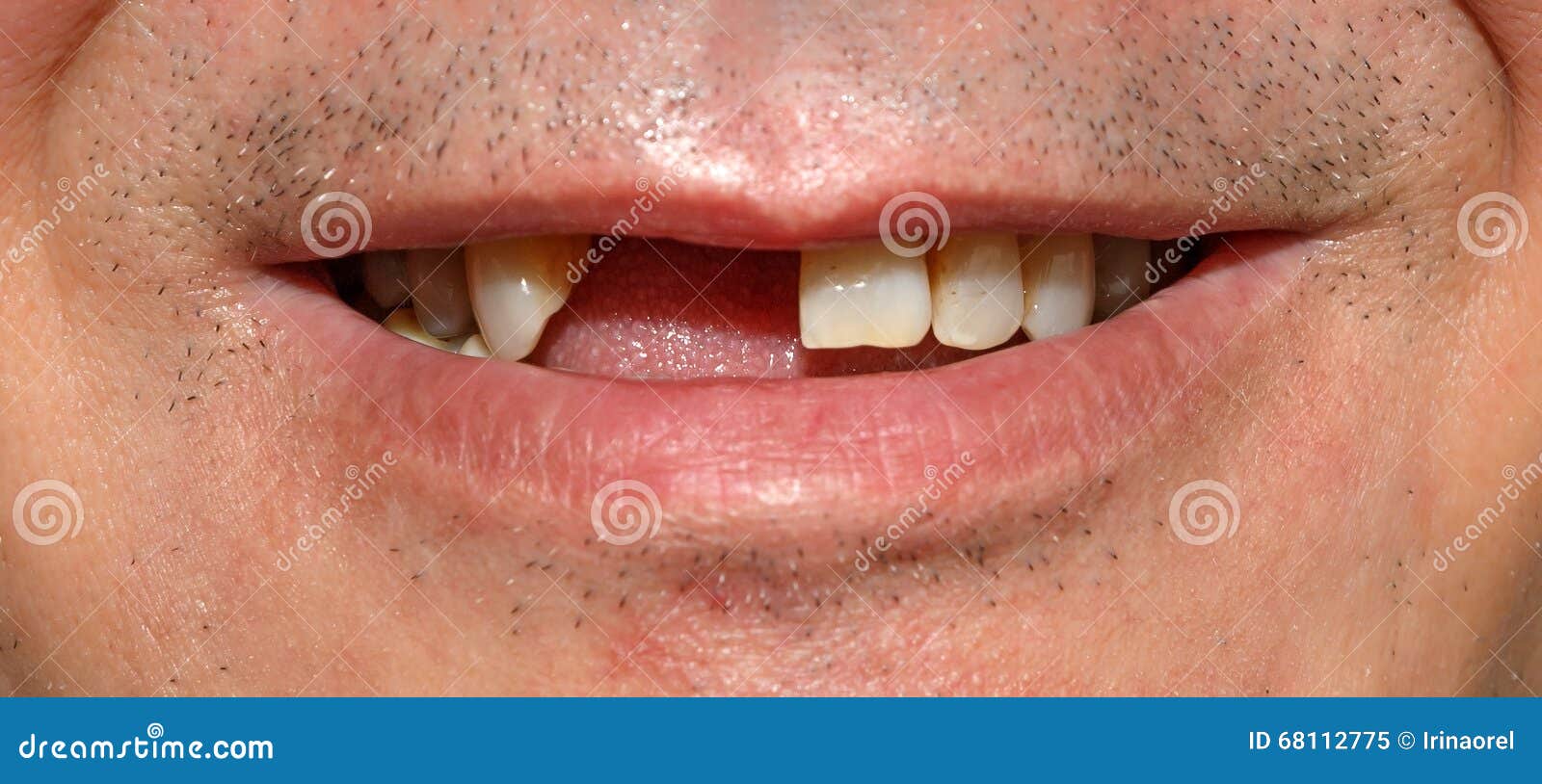 Smile without Two Front Teet Stock Image - Image of aesthetics ...