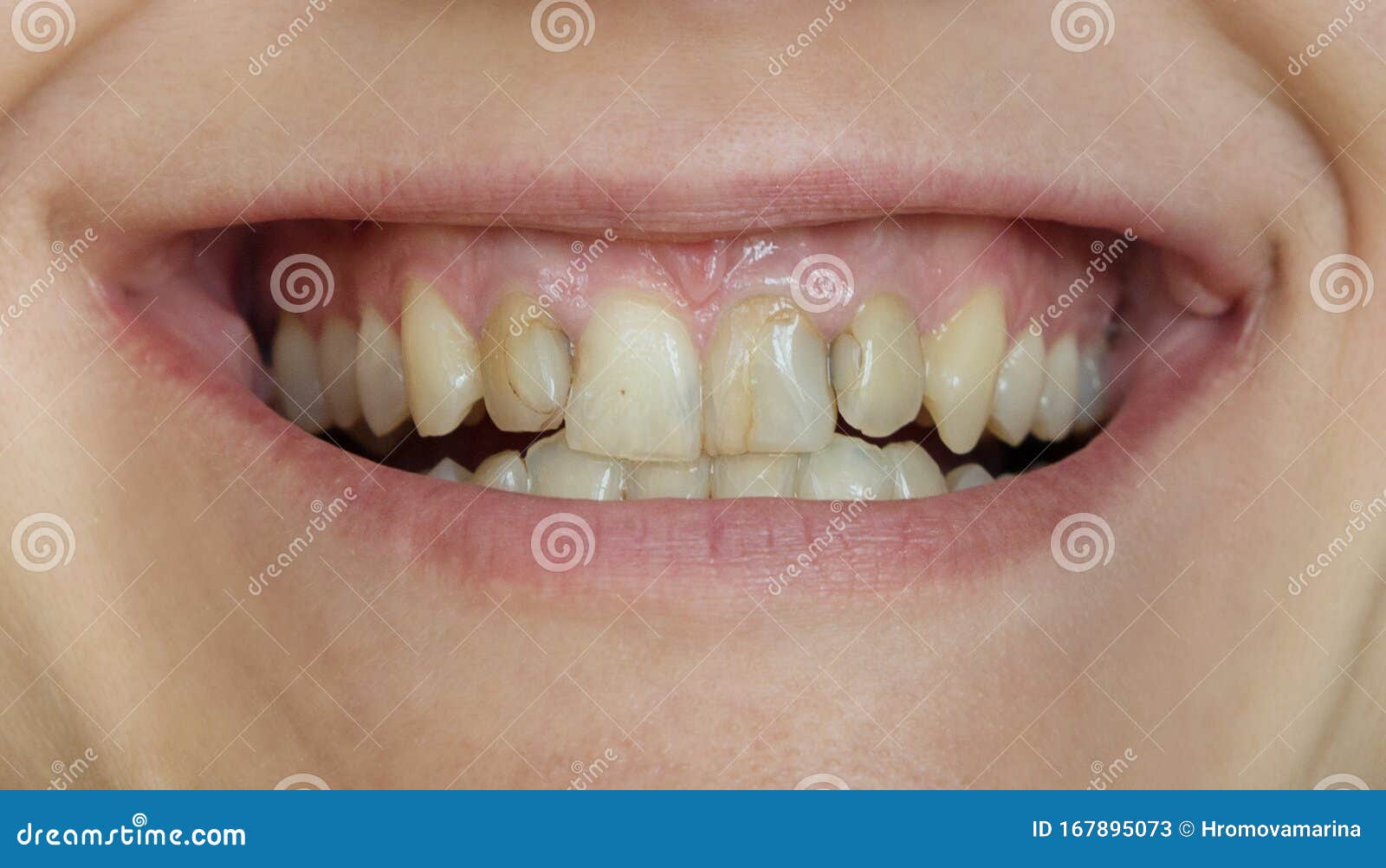 Smile with Ugly Crooked Yellow Teeth Stock Image - Image of dentistry ...