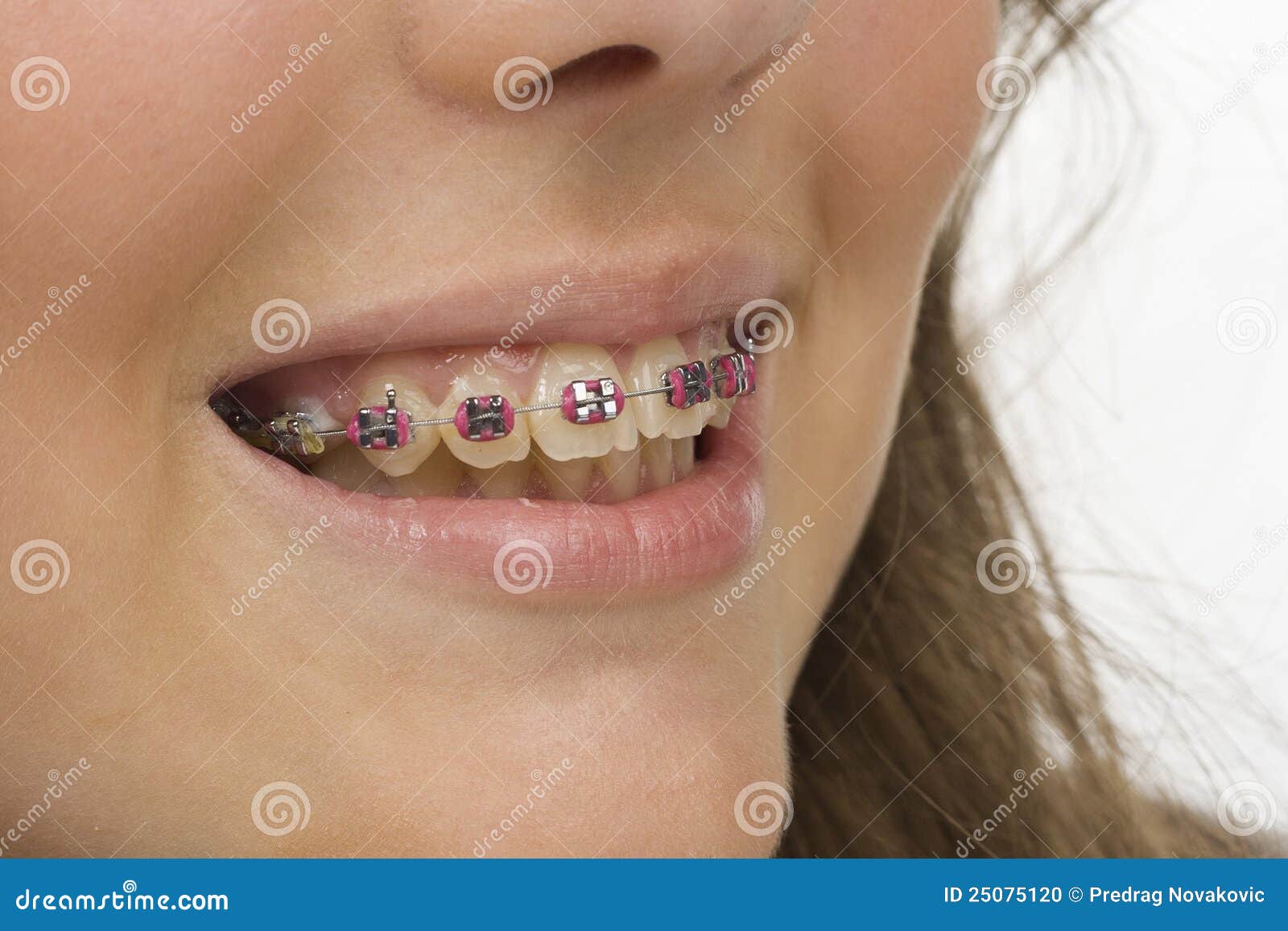 Smile of a Young Woman with Dentures Stock Photo - Image of girl, model ...
