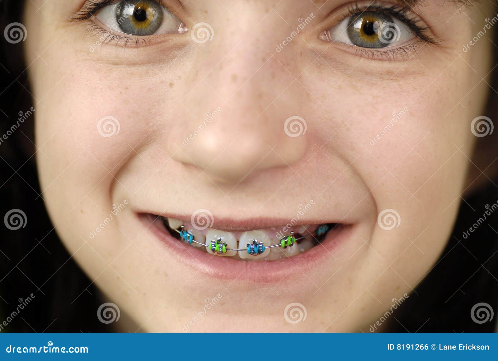 Smiling with Braces stock photo. Image of smile, fixing - 8191266