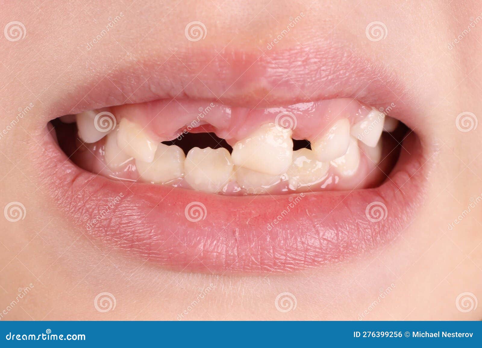 Smiling Child without Teeth Close-up Stock Photo - Image of person ...
