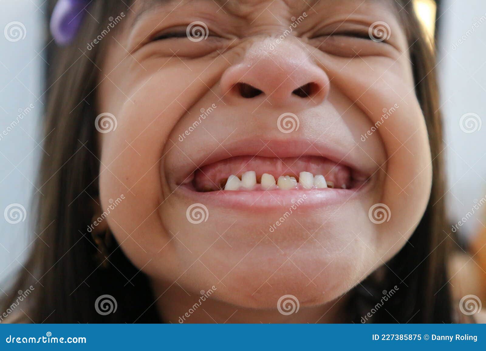 Smiling Girl with Broken Teeth Stock Image - Image of nose, laugh ...