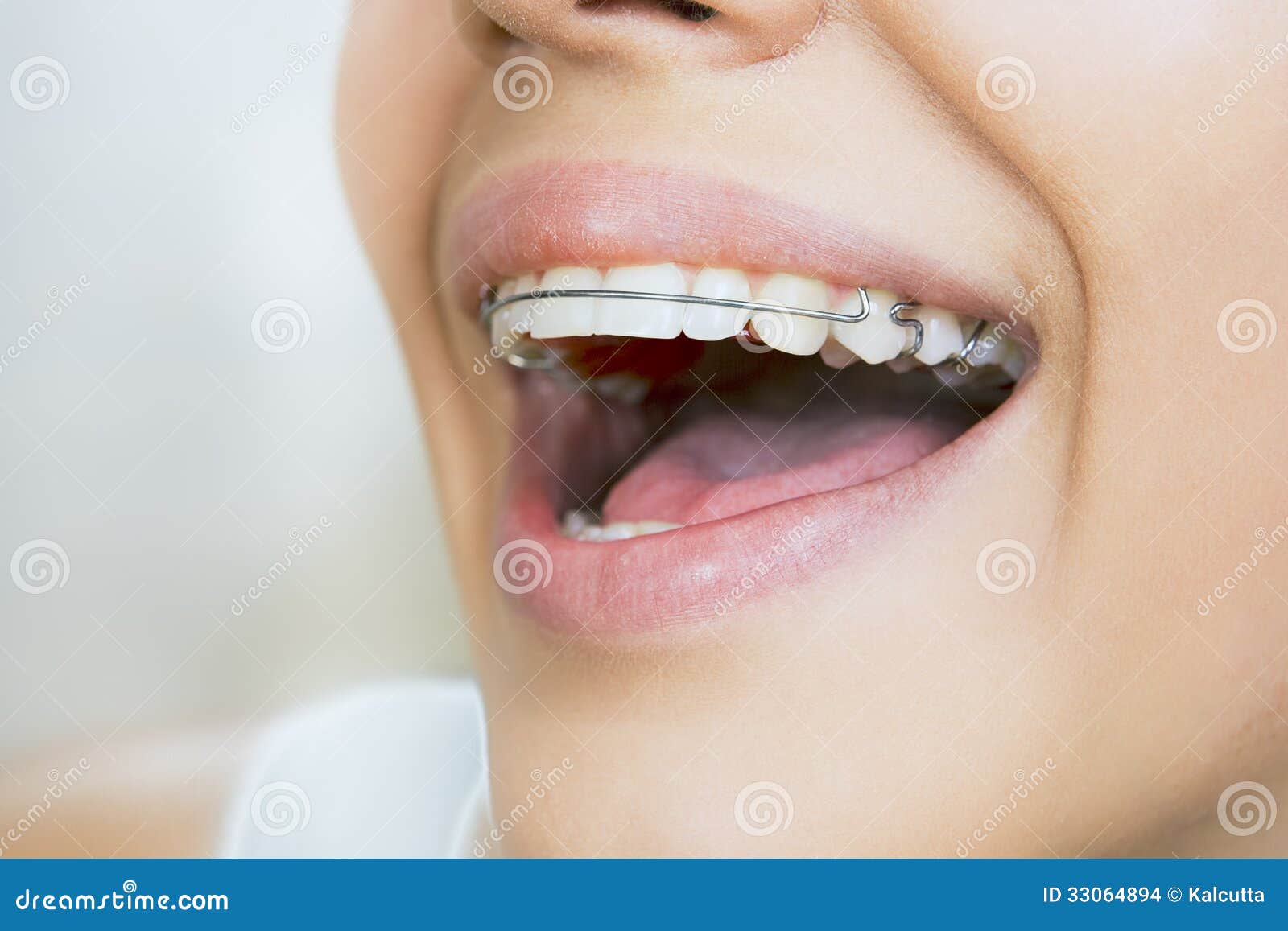 Smiling Girl with Retainer for Teeth Stock Photo - Image of individual ...