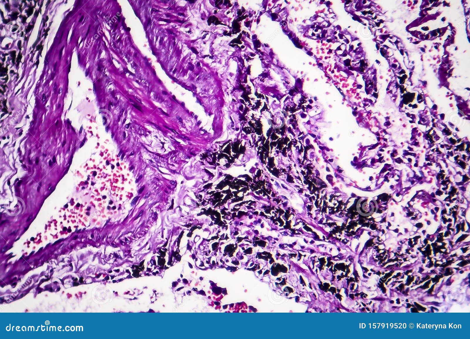 Smoker`s Lung, Histopathology, Light Micrograph Stock Photo - Image of ...