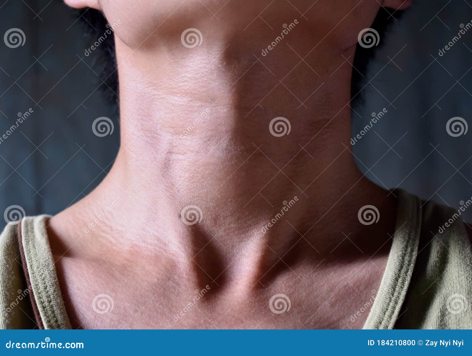 Smooth, Diffuse Thyroid Swelling of Southeast Asian, Burmese Young Man ...