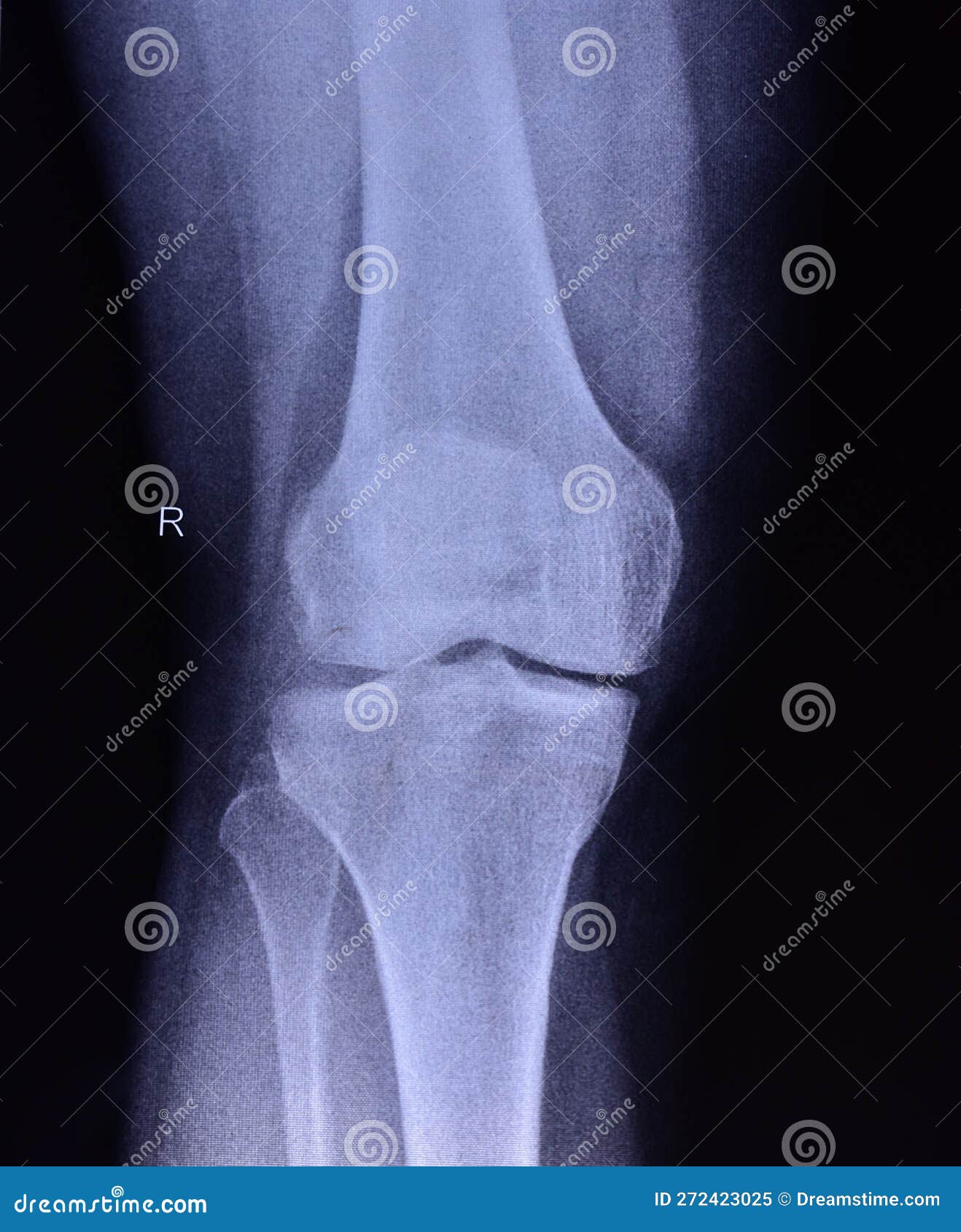 A Snapshot of the Knee Joint with a Diagnosis of Gonarthrosis ...