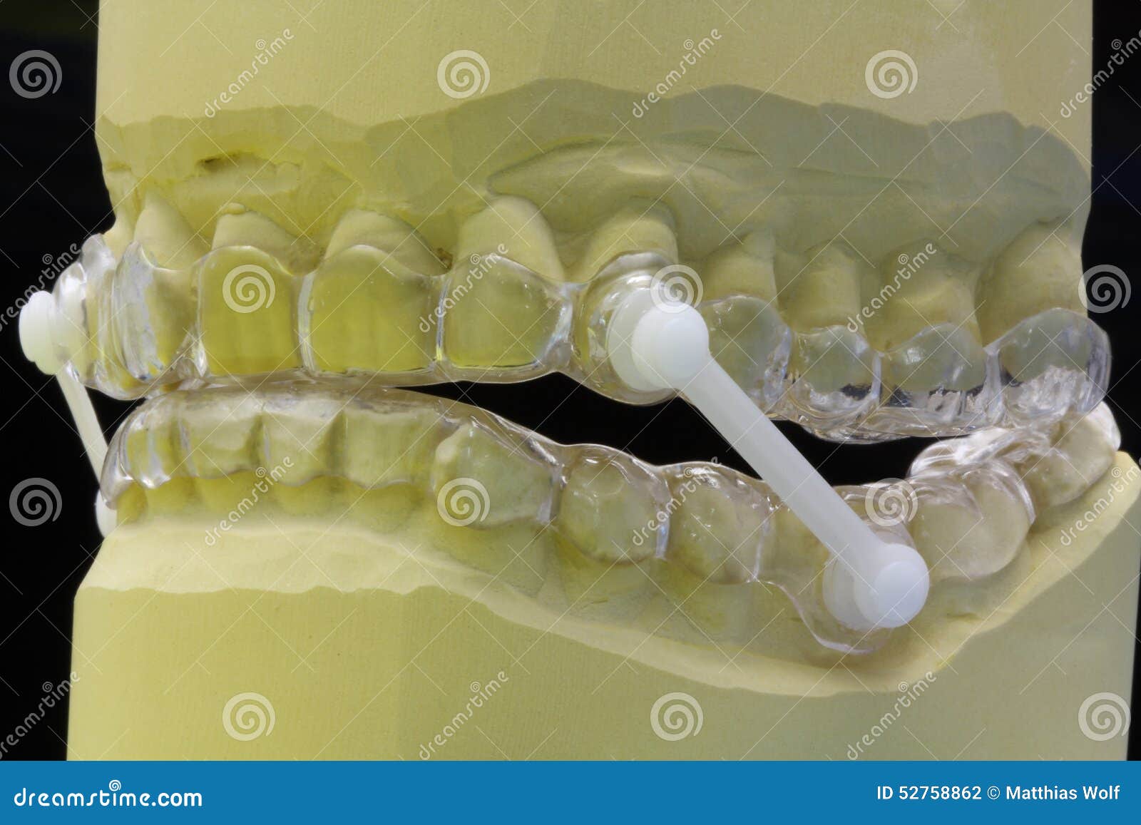 Snore splint stock photo. Image of avoid, therapy, disease - 52758862