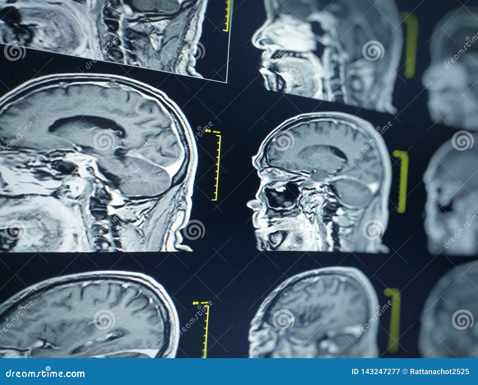 Soft and Blurry Image MRI Brain Showing in the LCD Moniter ,Medical ...