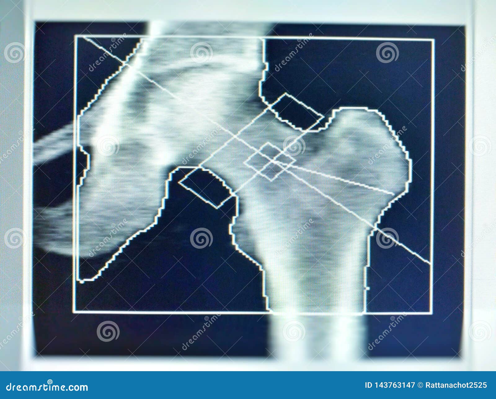 Soft And Blurry Image: Special Examination Medical Image Hip Bone ...