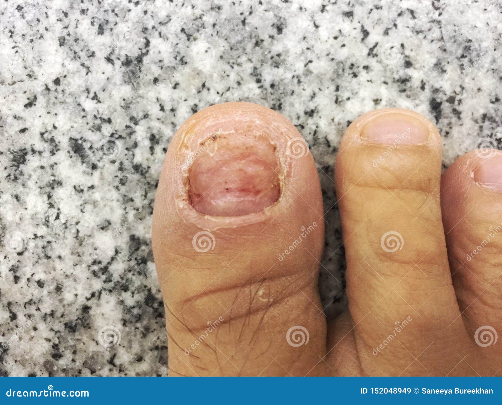 Soft Focusing Toenail Extract Stock Image - Image of soft, foot: 152048949