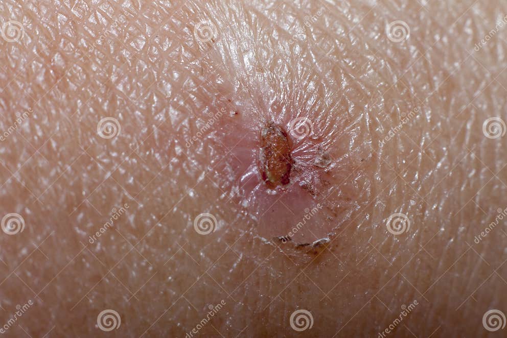 Soft Wounds on the skin stock photo. Image of close, frayed - 86595924