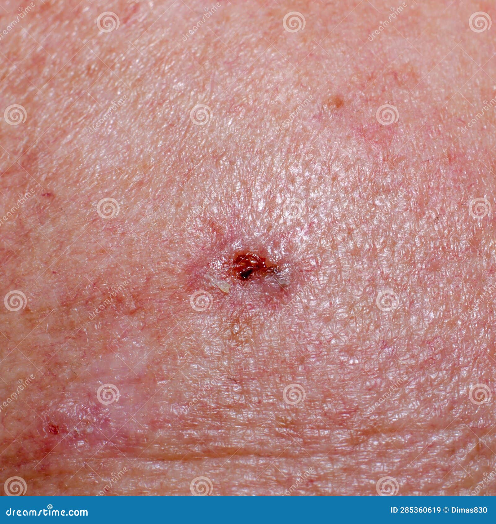 Solar Keratosis or Basalioma on Human Scalp Stock Image - Image of mole ...