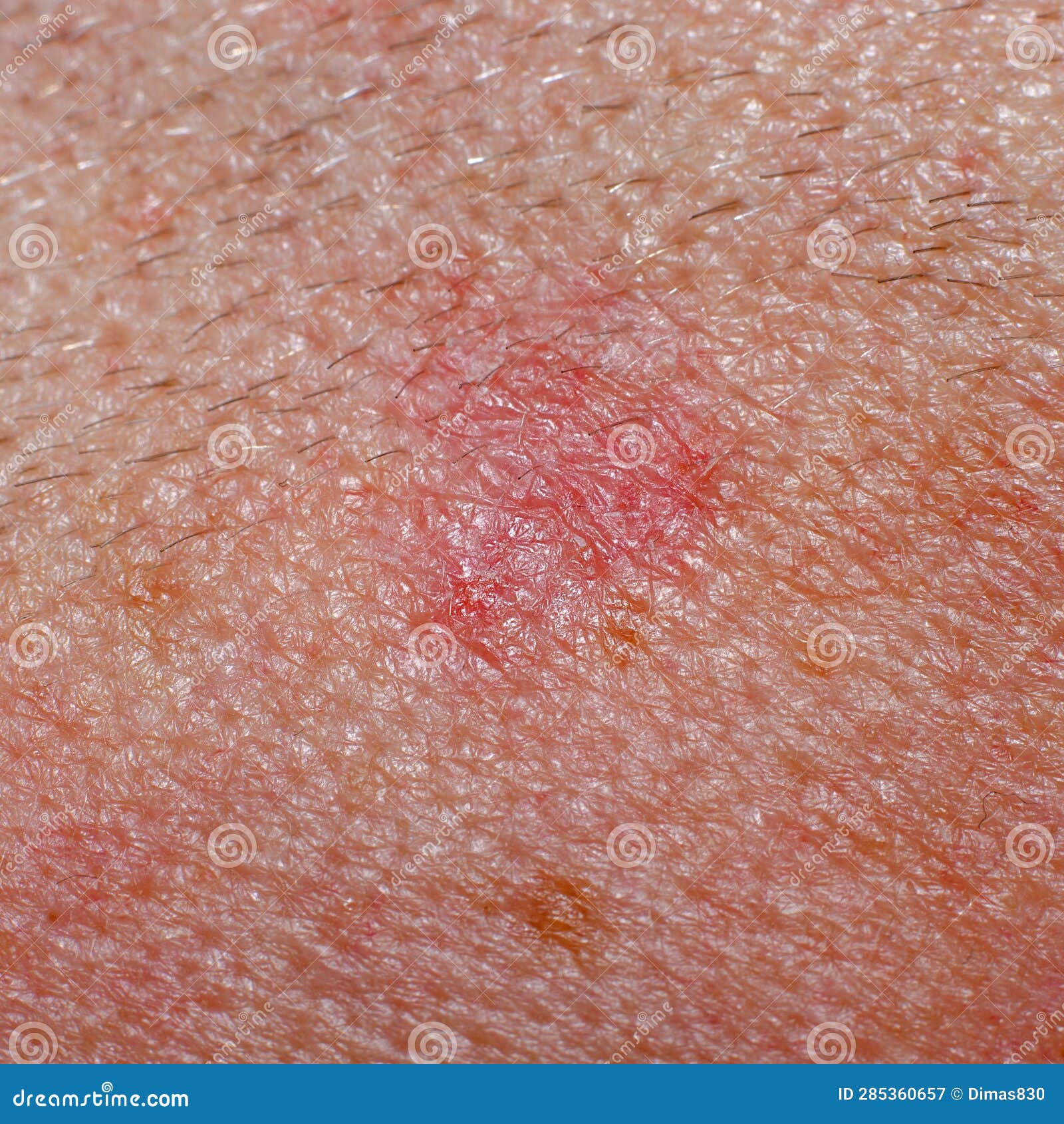 Solar Keratosis or Basalioma on Human Scalp Stock Image - Image of ...