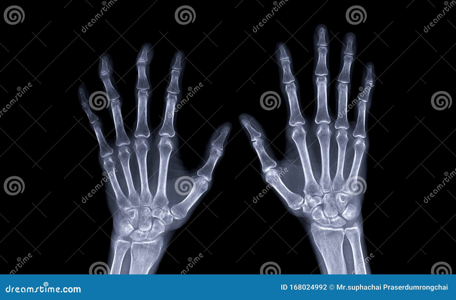 Xray Image of Both Hand AP View I Stock Photo - Image of doctor, index ...