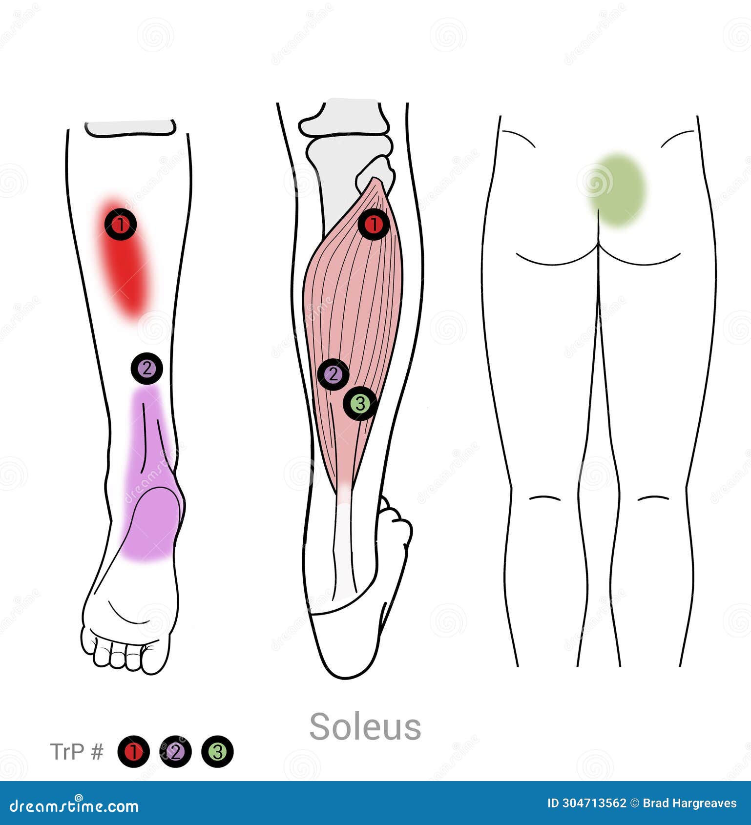 Soleus: Treating Myofascial Trigger Points In The Soleus Calf Muscle Stock Illustration ...