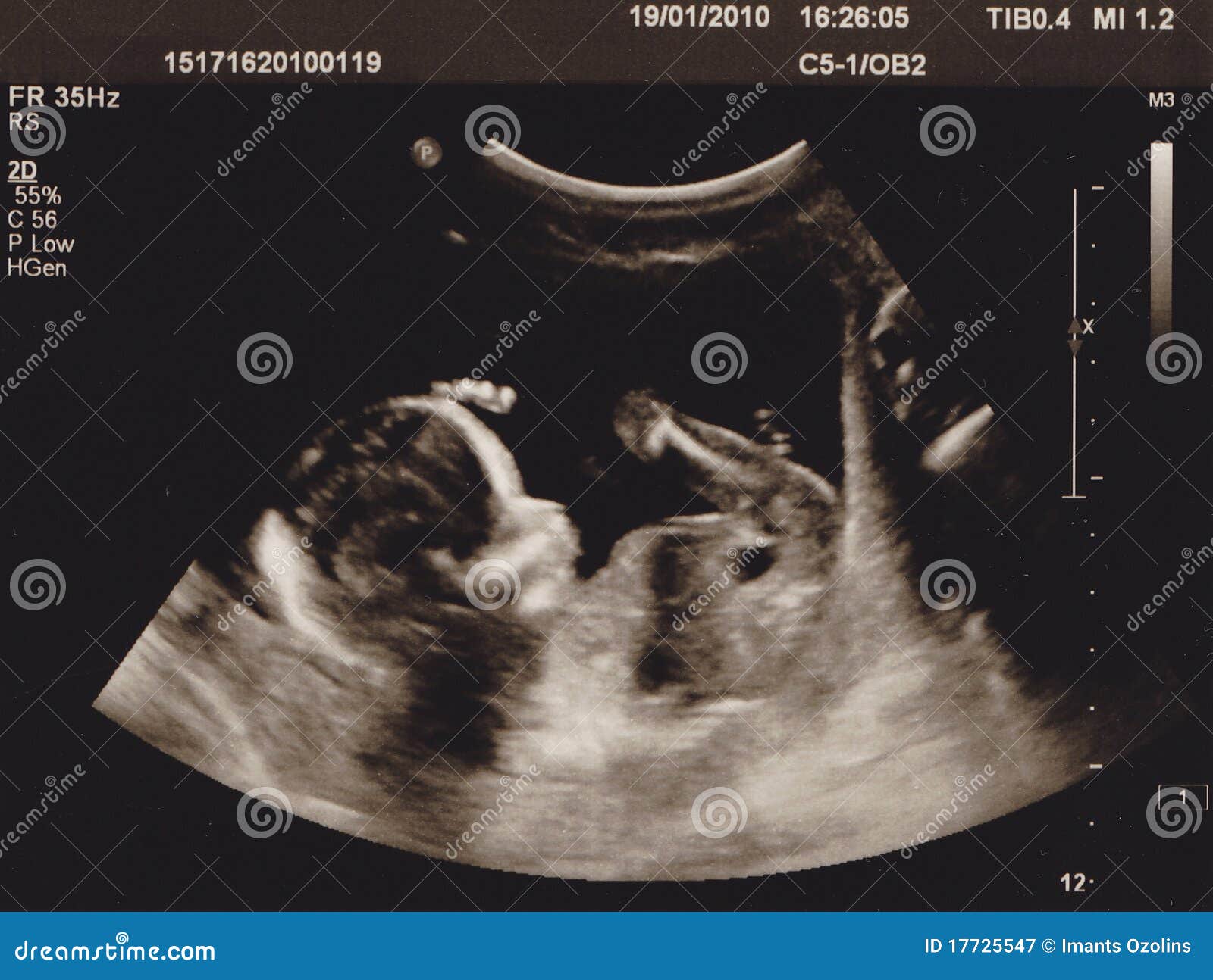 Sonografía Fotografía de archivo libre de regalías - Imagen: 17725547