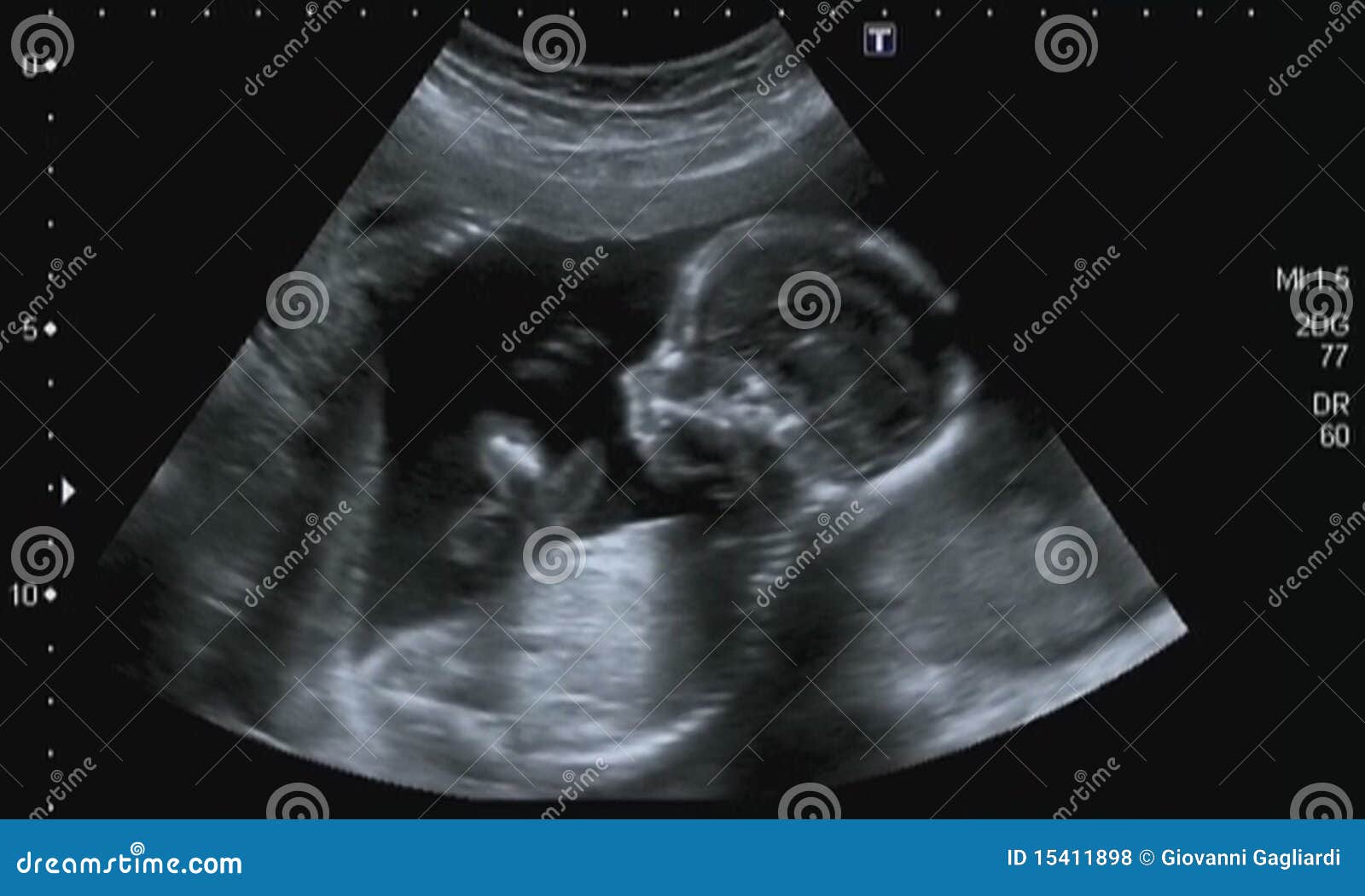 Sonografía Obstétrica Fotos de archivo libres de regalías - Imagen ...