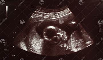 Sonogram of fetus stock photo. Image of medical, embryo - 12871312