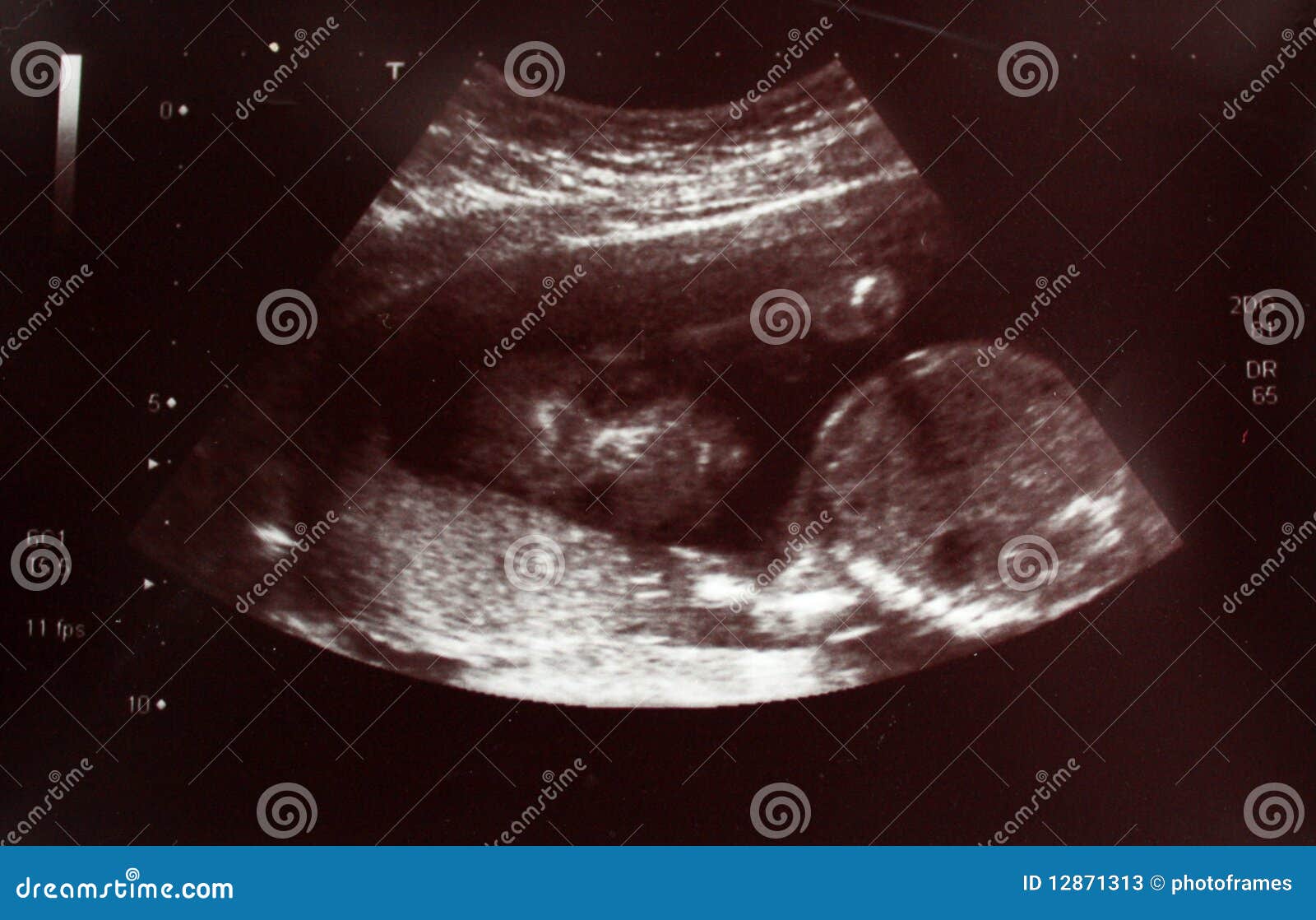 Sonogram of a human foetus stock image. Image of amitai - 12871313