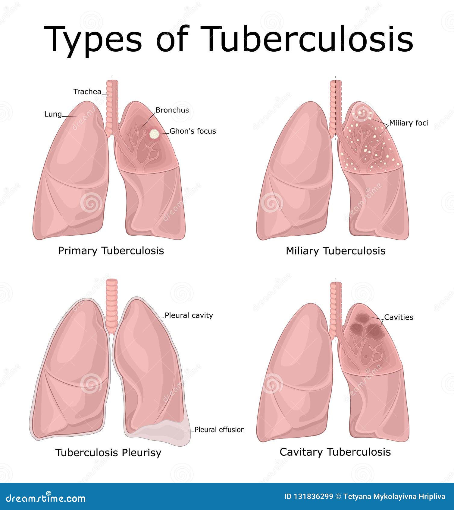 Soorten tuberculose vector illustratie. Illustration of medicijn ...