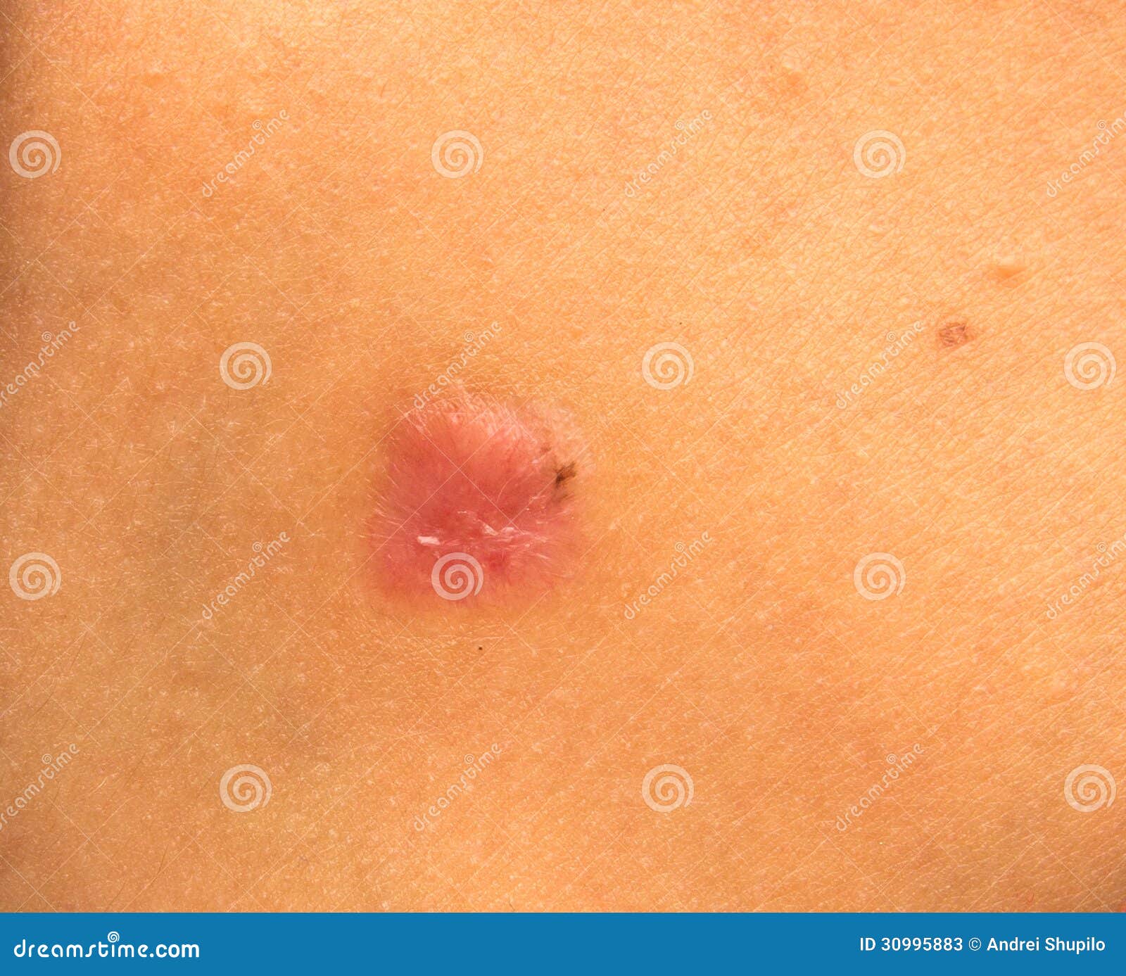Sore heals the skin stock image. Image of scab, painful - 30995883