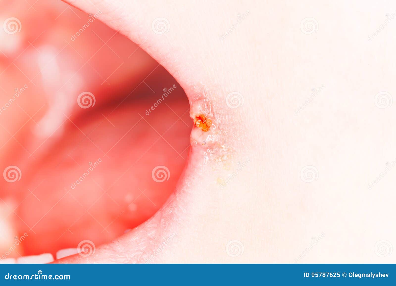 Stomatitis And Herpes In The Child Mouth Close-up Royalty-Free Stock ...