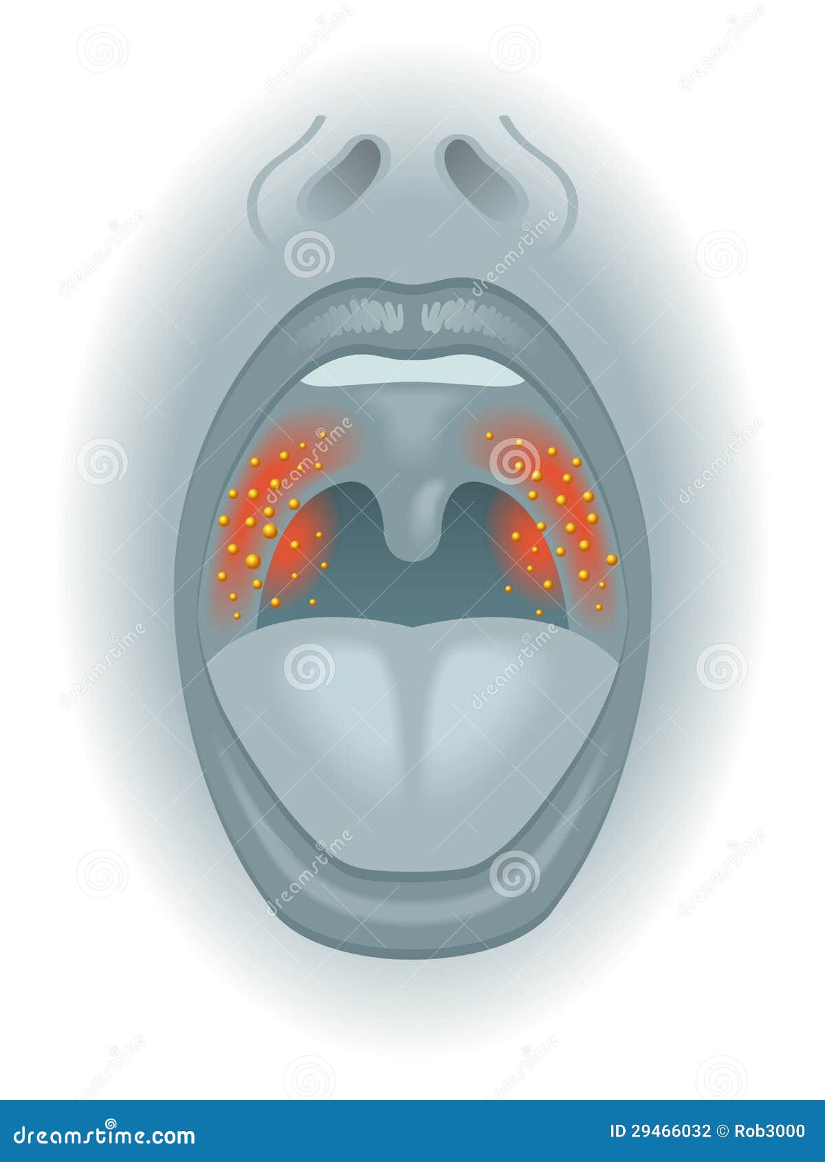 Sore throat stock vector. Illustration of pharynx, fever - 29466032