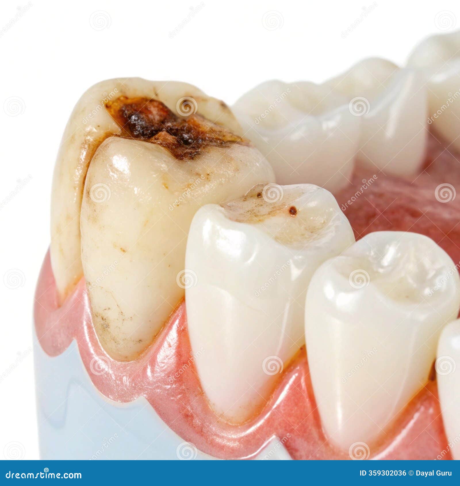 Sore Tooth Amidst Healthy Teeth on White Background Stock Illustration ...