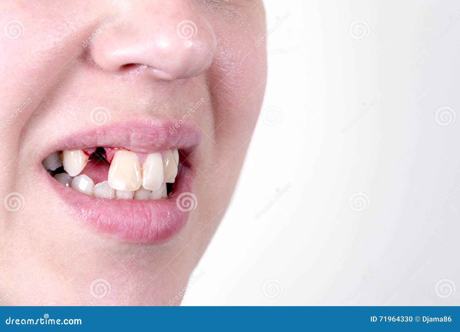 Sorriso Da Mulher Sem Dentes Anteriors Foto de Stock - Imagem de lago ...