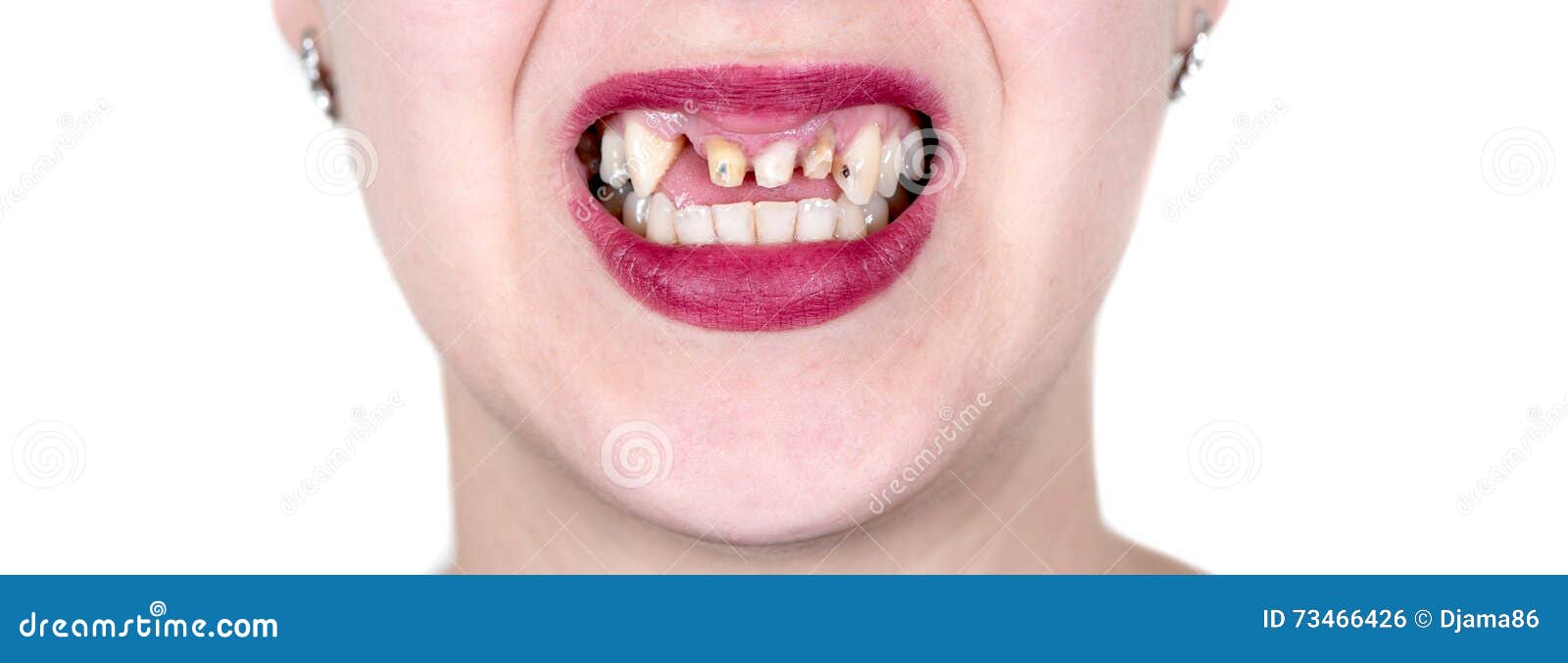 Sorriso Da Mulher Sem Dentes Anteriors Foto de Stock - Imagem de ...
