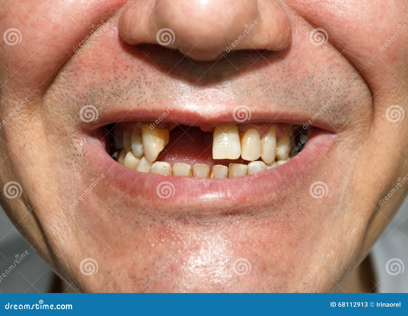 Sorriso sem dentes imagem de stock. Imagem de povos, alegria - 68112913