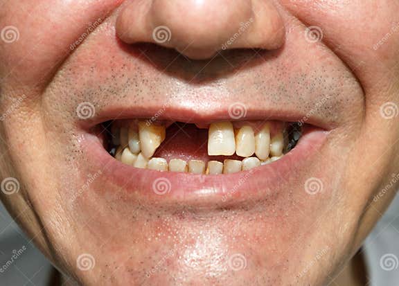 Sorriso sem dentes imagem de stock. Imagem de povos, alegria - 68112913