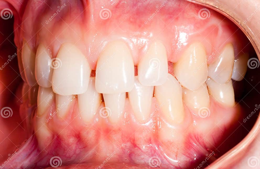 Space between teeth stock image. Image of oral, clinical - 41061853