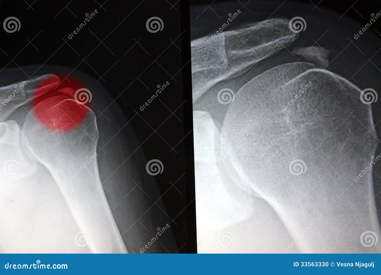 Spalla Di Painfull, Tendinite Calcificante, Tendinite Fotografia Stock ...