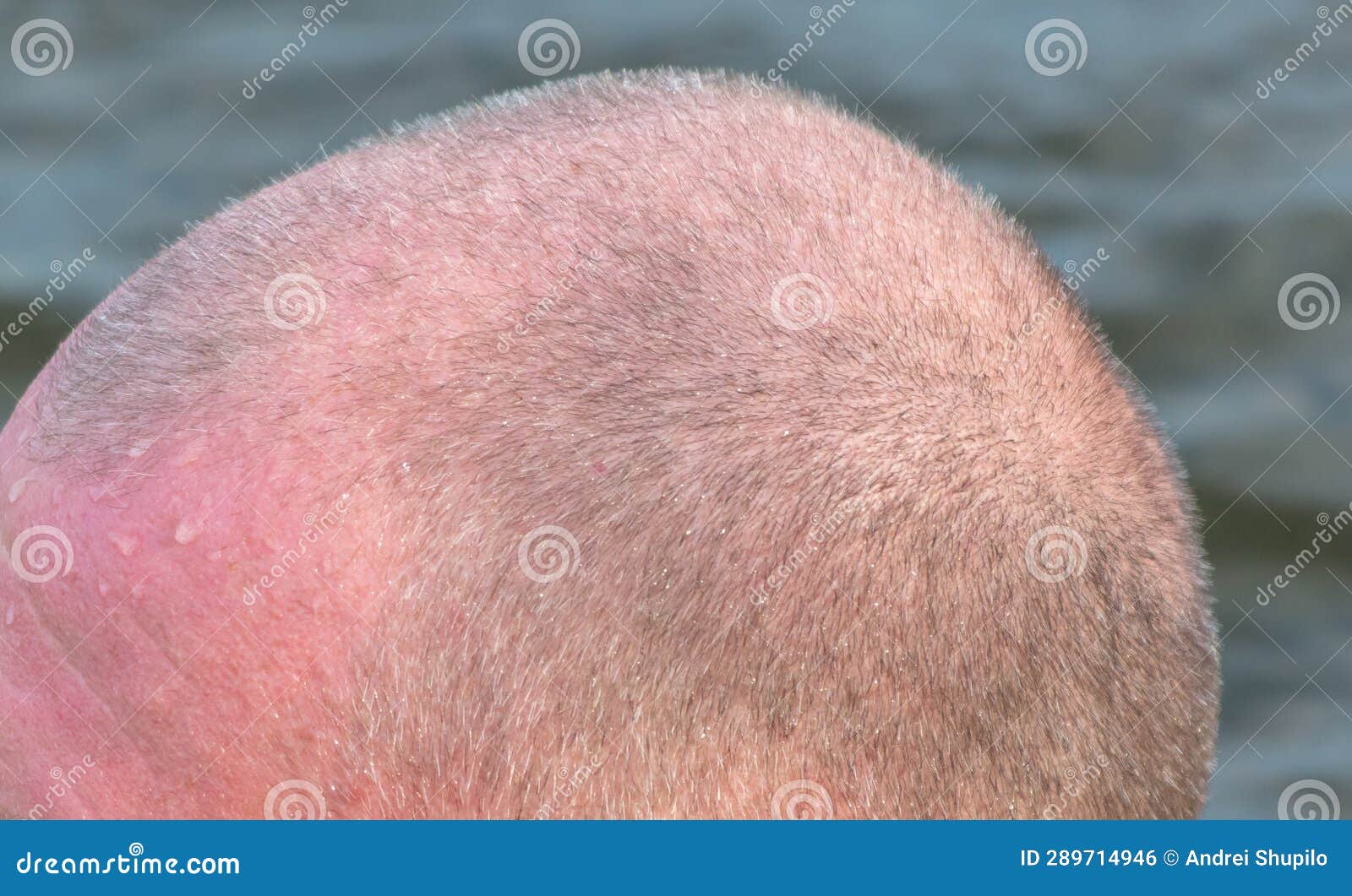 Sparse Hair on the Head of a Man Stock Photo - Image of dark, closeup ...