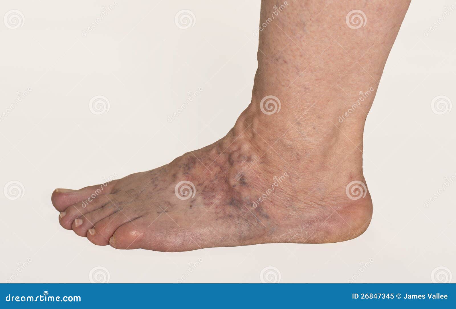 Spataders stock afbeelding. Image of huid, aders, slagader - 26847345