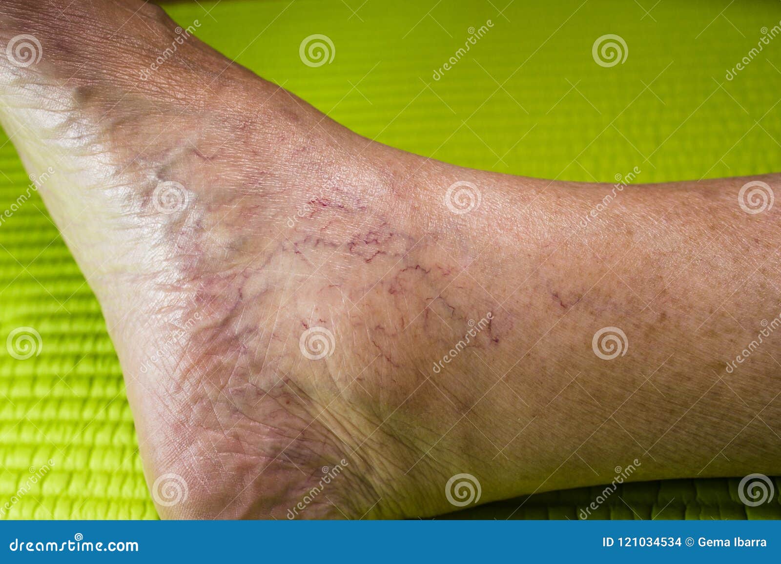 Spataders in De Enkel Van Een Oudere Vrouw Stock Foto - Image of huid ...