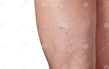 Spataders En Capillaire Aders in De Benen Stock Foto - Image of ...