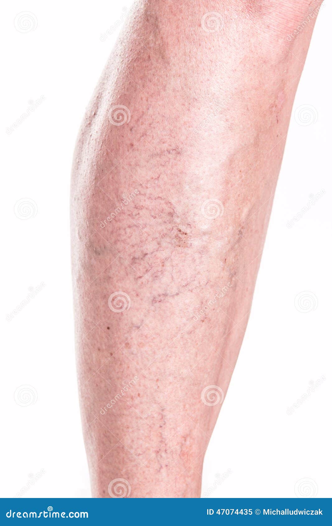 Spataders Op De Benen Van Vrouw Stock Afbeelding - Image of geneeskunde ...