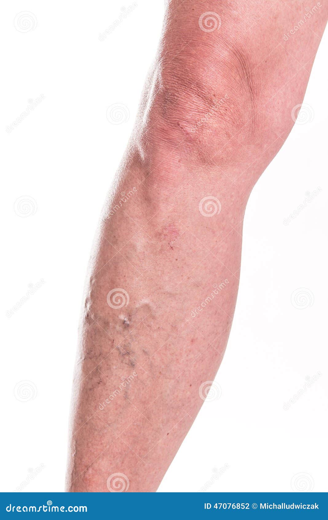 Spataders Op De Benen Van Vrouw Stock Foto - Image of beweging, druk ...