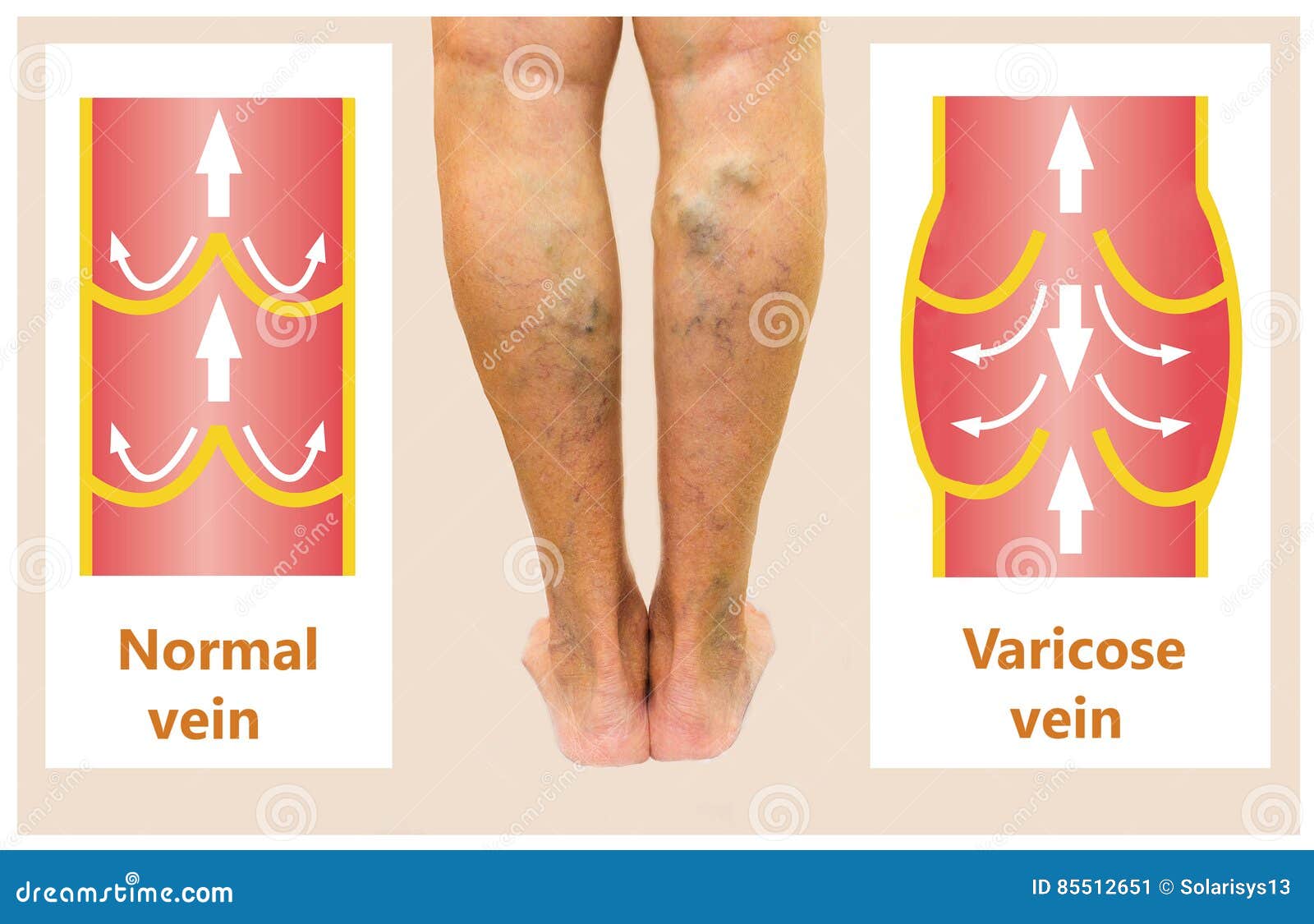 Spataders Op Een Vrouwelijk Hoger Been Stock Afbeelding - Image of zorg ...