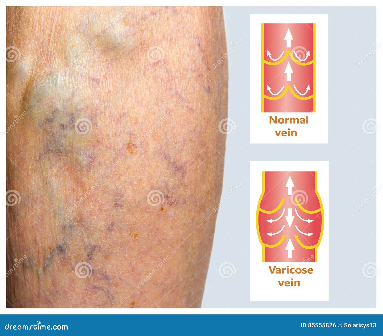 Spataders Op Een Vrouwelijk Hoger Been Stock Foto - Image of oudste ...