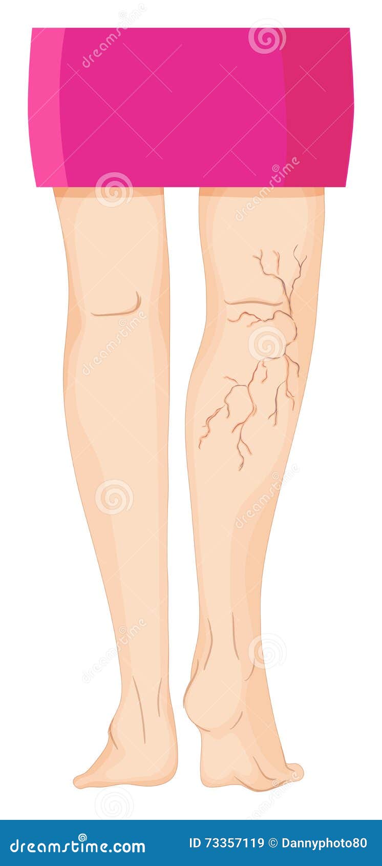 Spataders Op Menselijke Benen Vector Illustratie - Illustration of ...