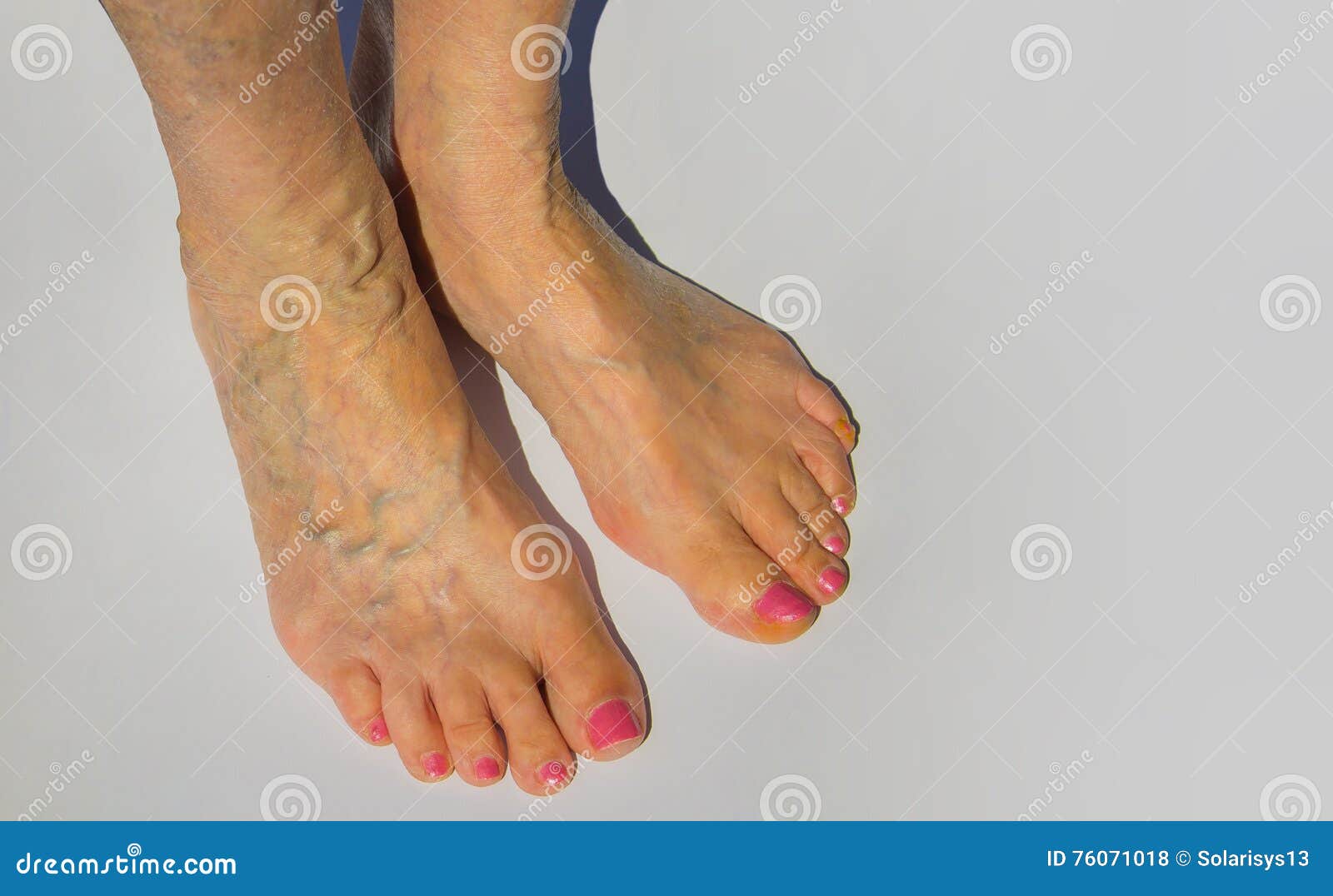 Spataders Op Vrouwelijke Benen Stock Foto - Image of flebotomie ...