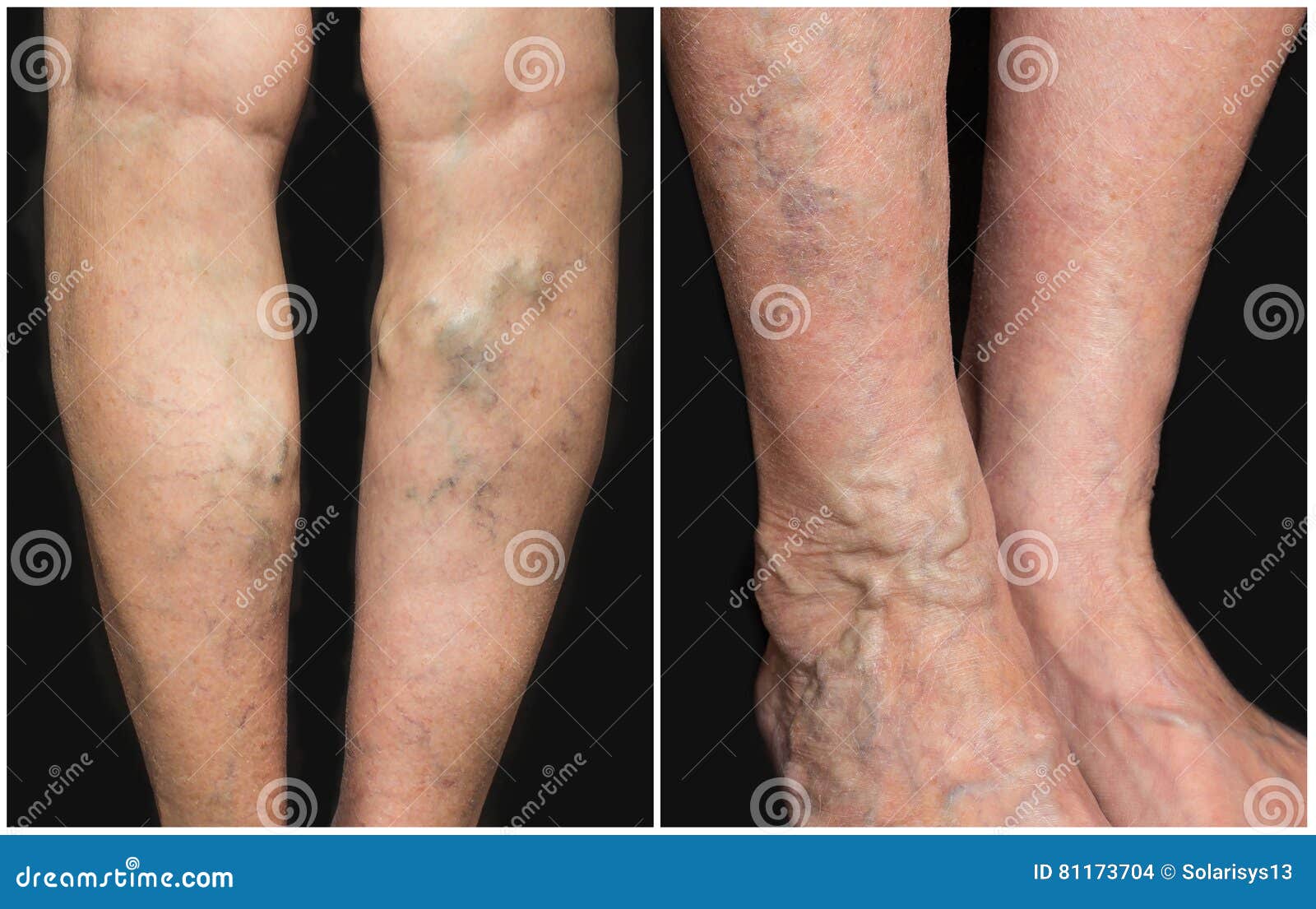 Spataders Op Vrouwelijke Benen Stock Foto - Image of spin, leeftijd ...