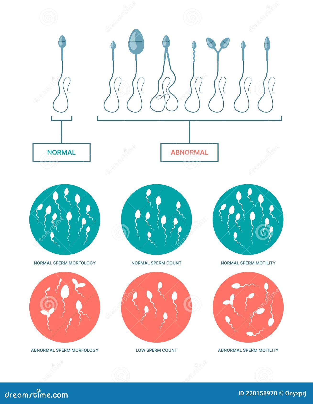 Spermogram. Medical Infographic with Healthy and Damaged Spermatozoa ... Spermogram. Medical Infographic with Healthy and Damaged Spermatozoa ...
