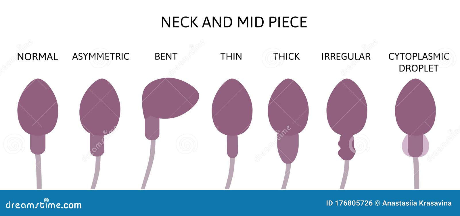 Spermogram and Semen Parameters, Teratozoospermia, Normal and Abnormal ...