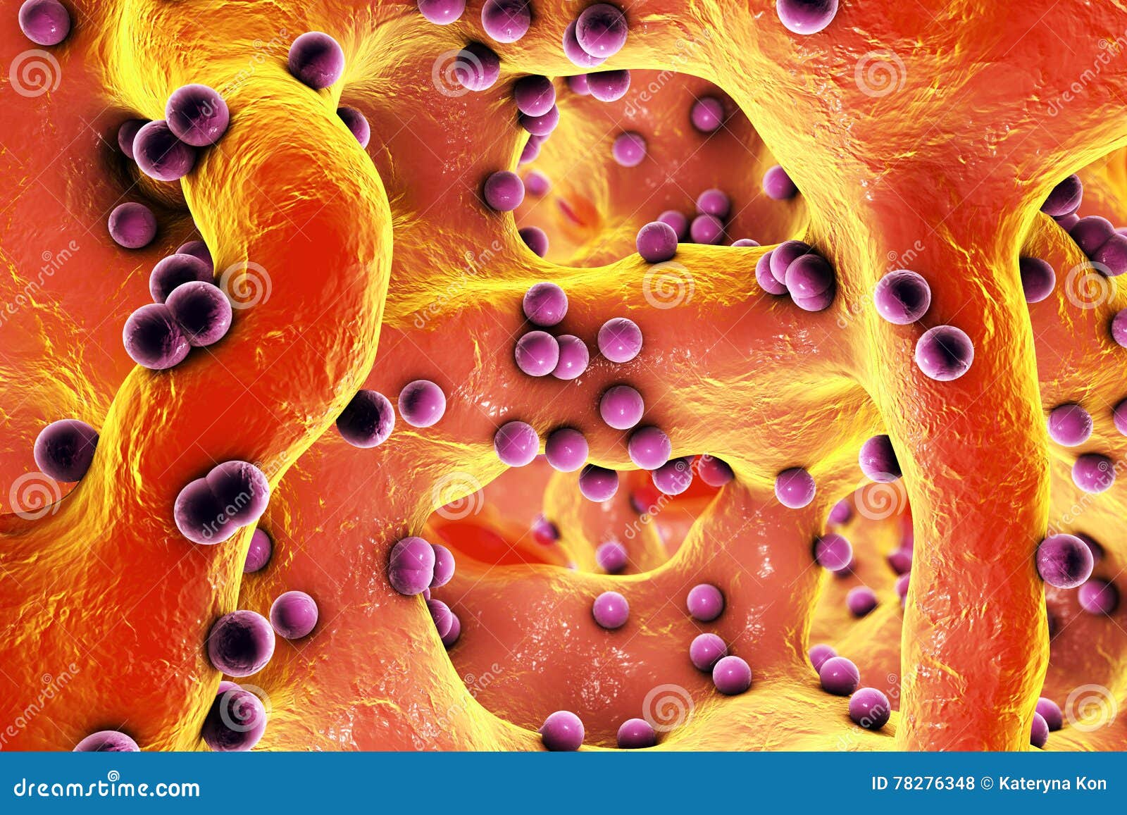 Spherical Bacteria Inside Bone Tissue Stock Illustration - Illustration ...